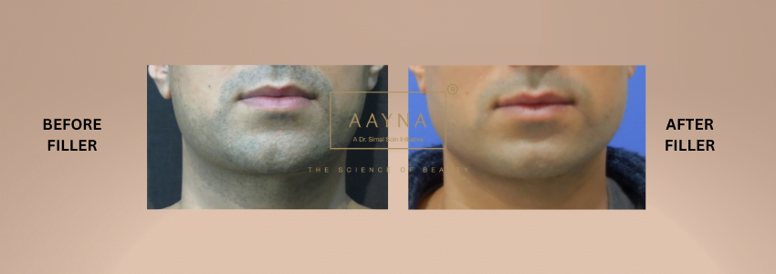 Lip Fillers for Men: Use, Benefits, Before After
