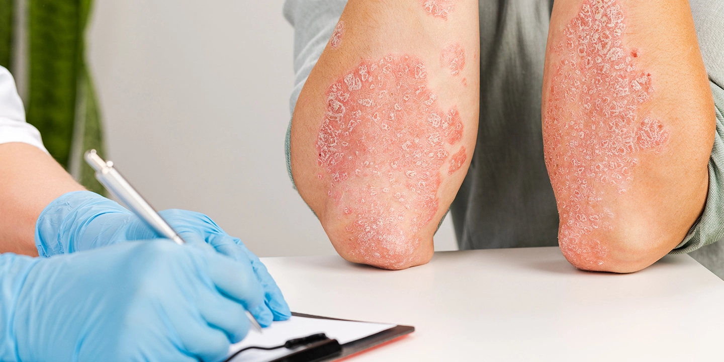 5 Signs and Symptoms of Psoriasis Disease