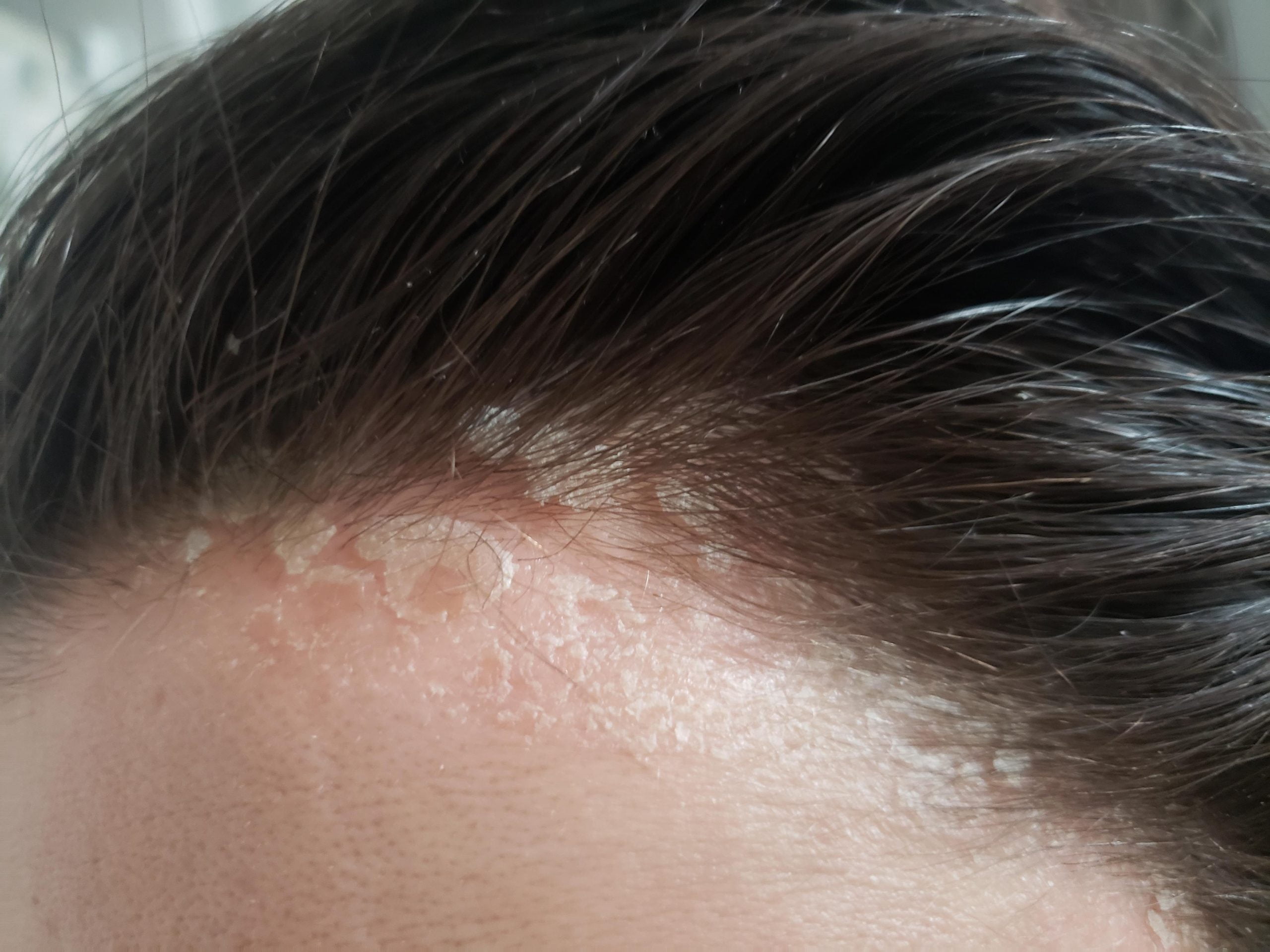 5 Tips to Sooth Sunburn on Scalp & Hairline