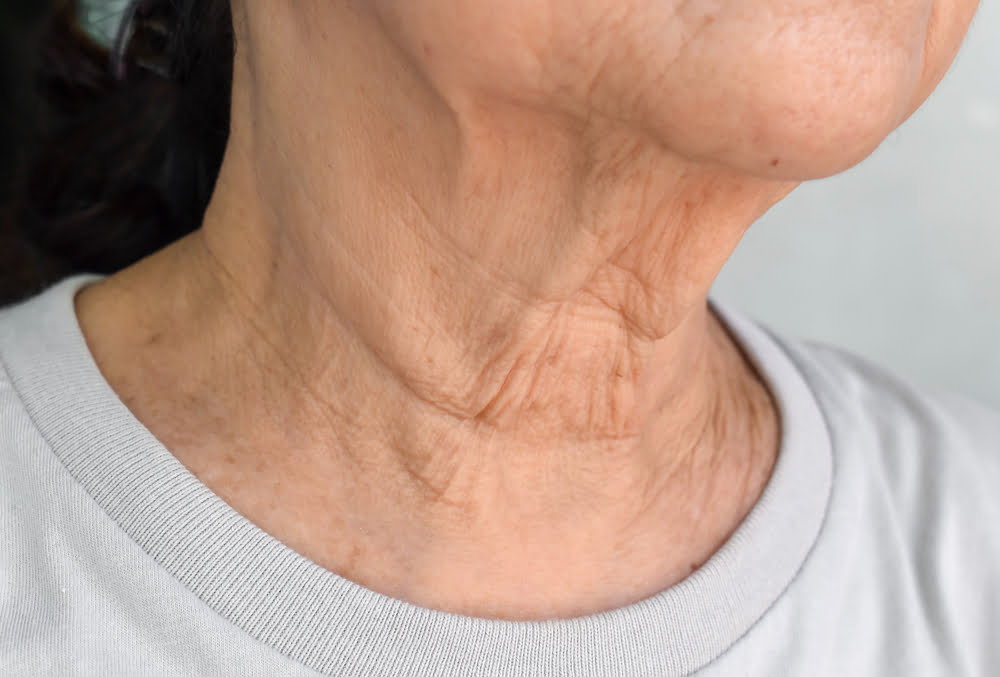 Neck Wrinkles: Meaning, Causes and Solutions