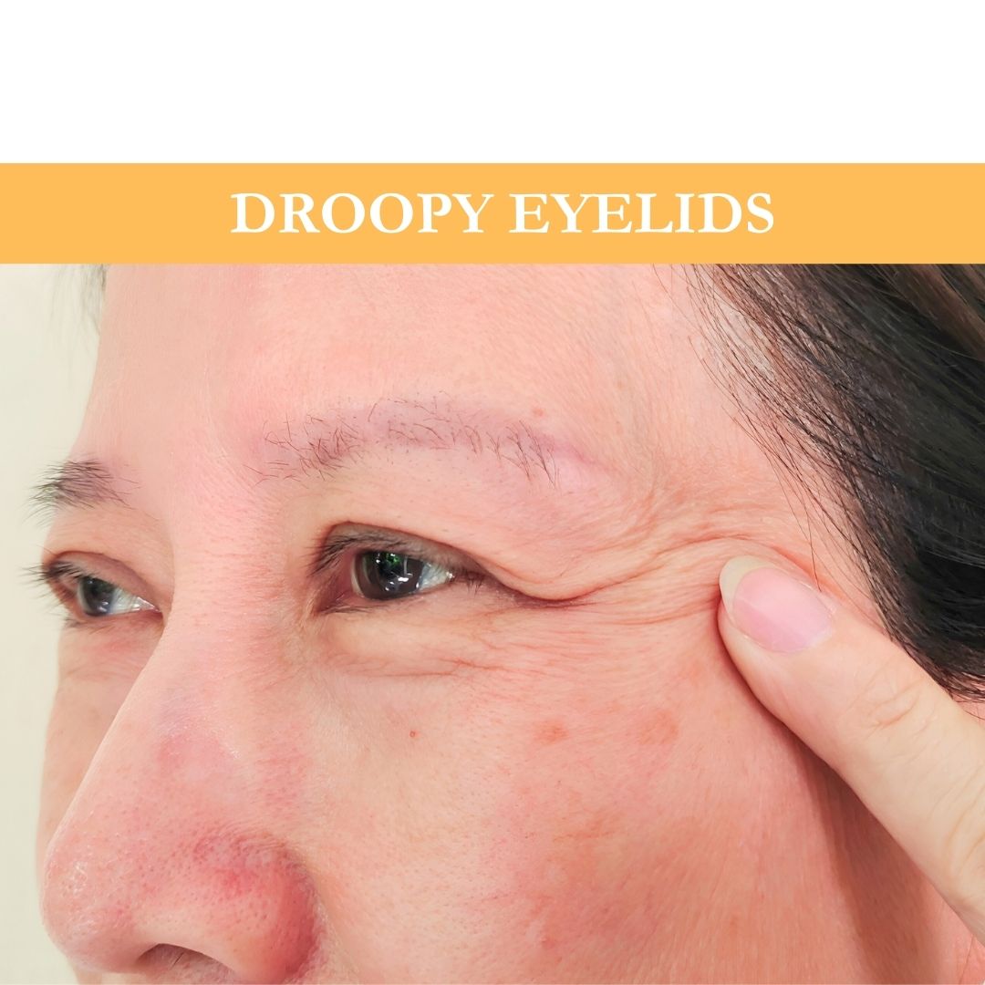 Droopy Eyelids: Everything You Need To Know About Ptosis