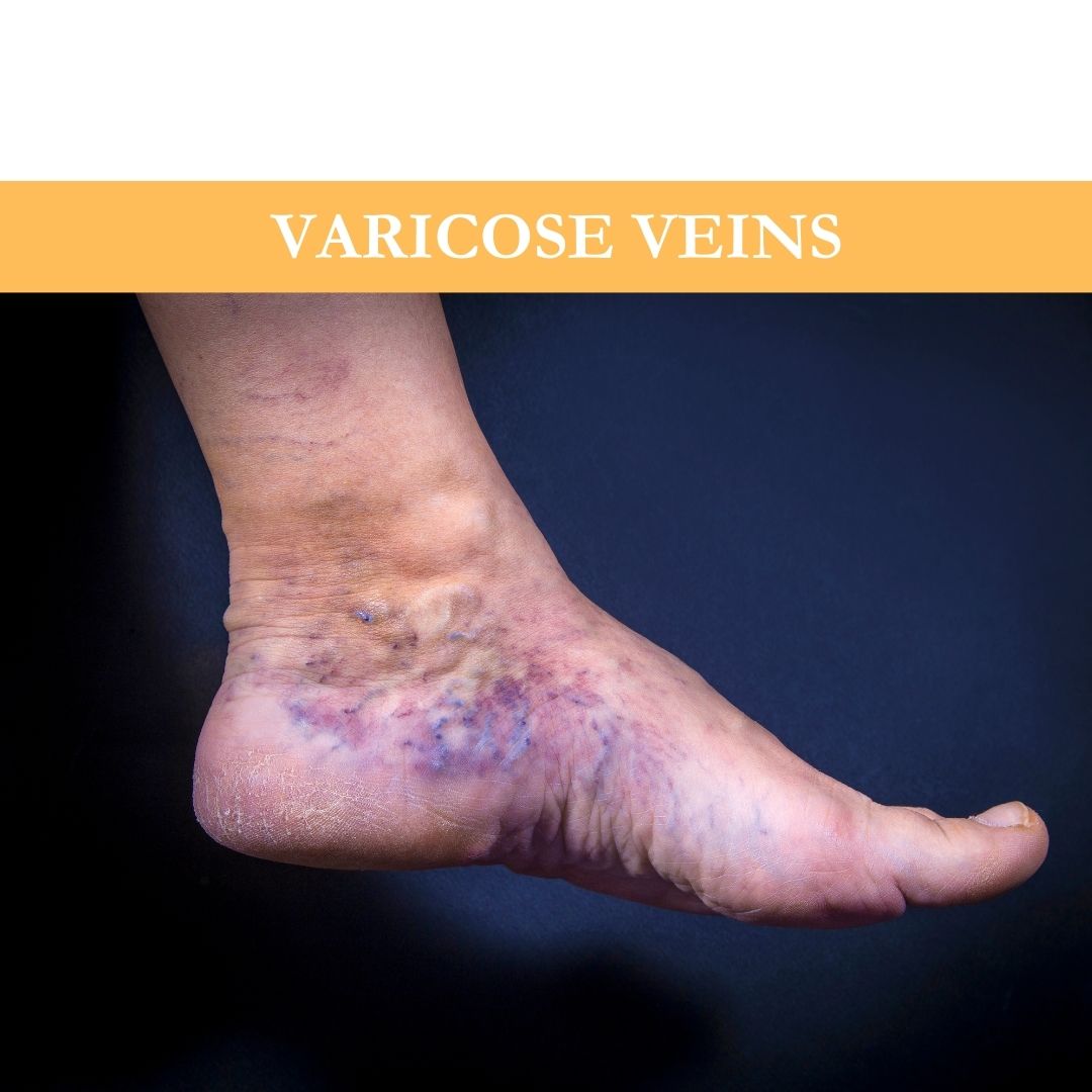 Varicose Veins: Causes, Stages, Treatments, and FAQs