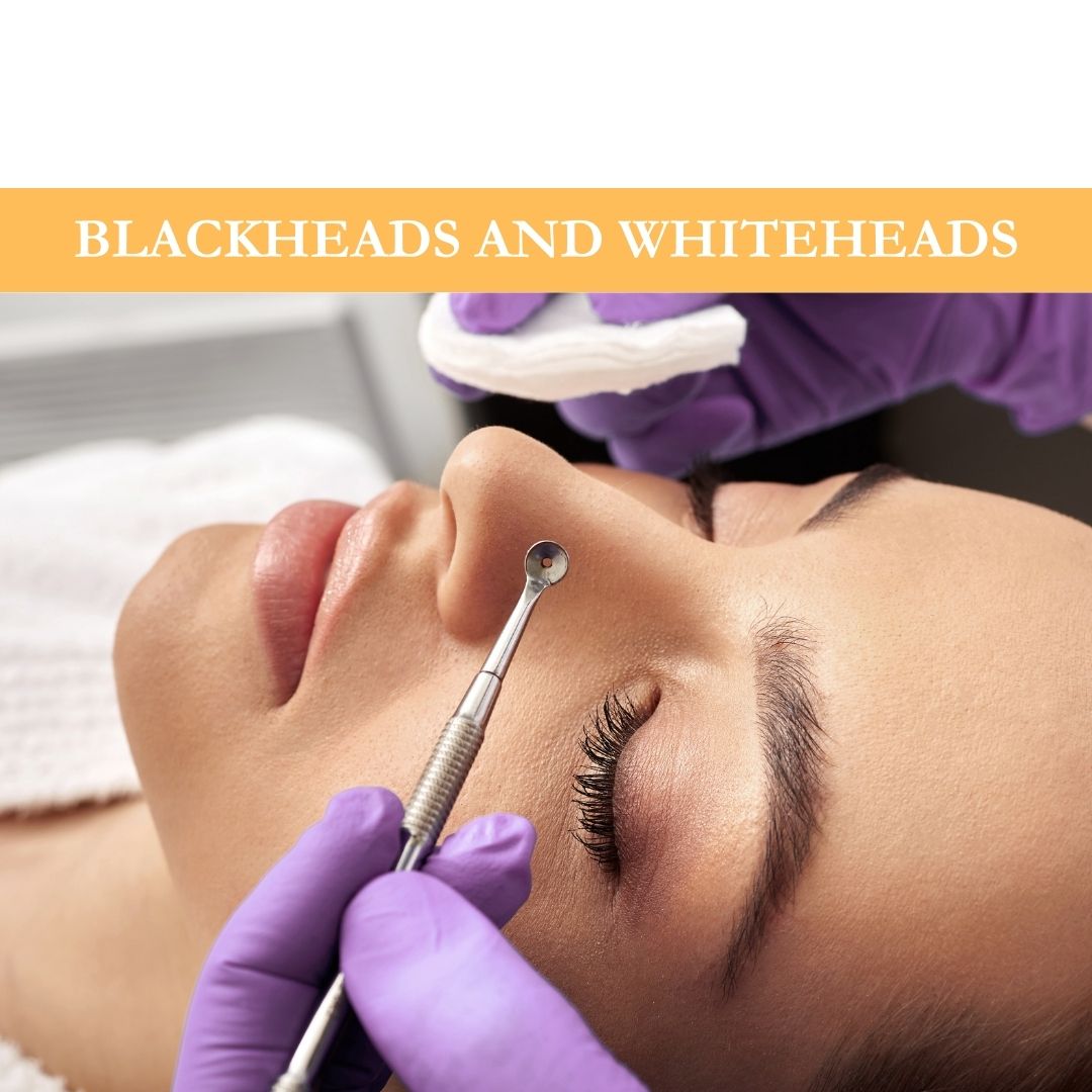 Blackheads and Whiteheads- What's the Difference?