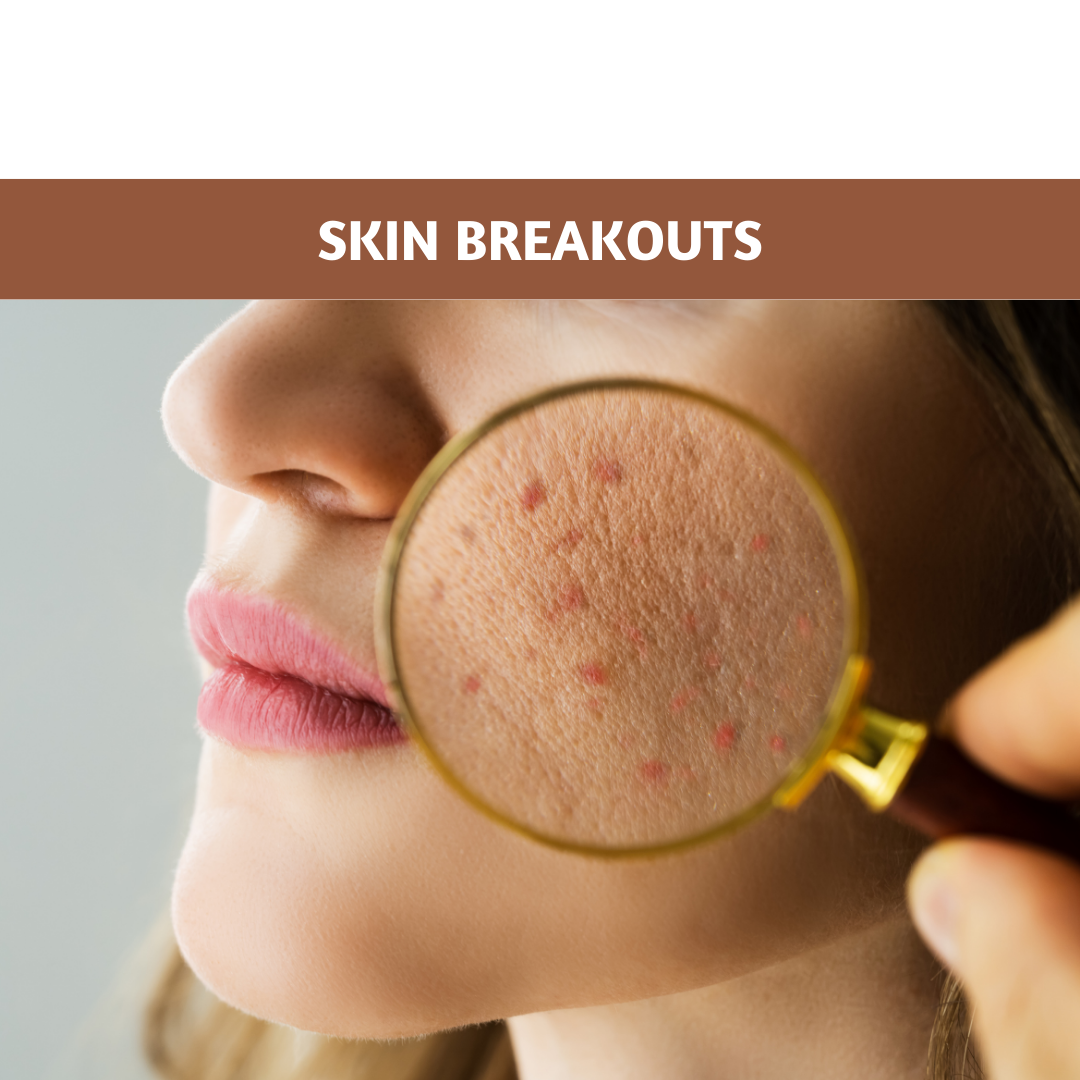 Skin Breakouts: Prevention, Causes, and FAQs