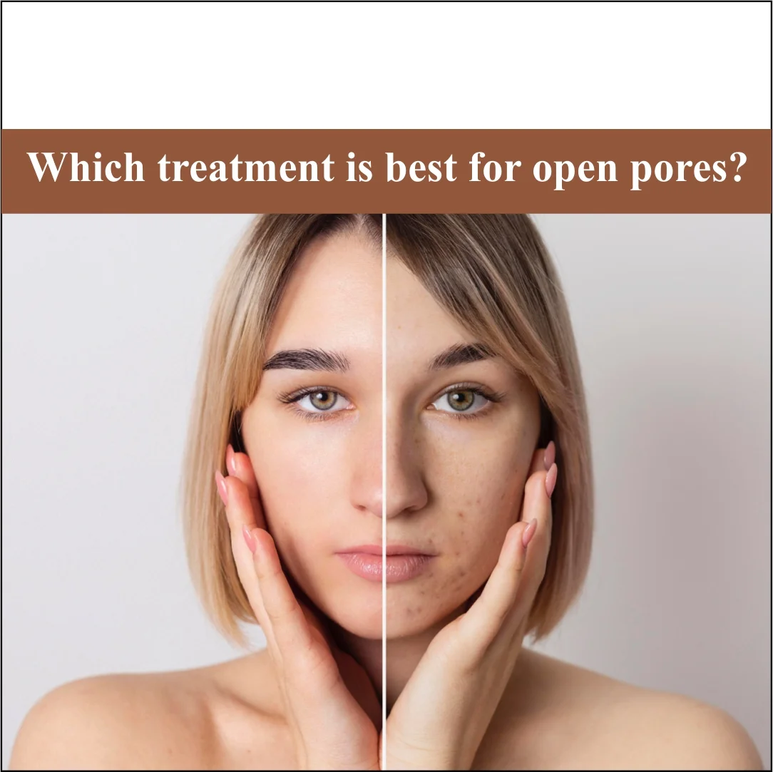 Which Treatment Is Best for Open Pores? - AAYNA Clinic