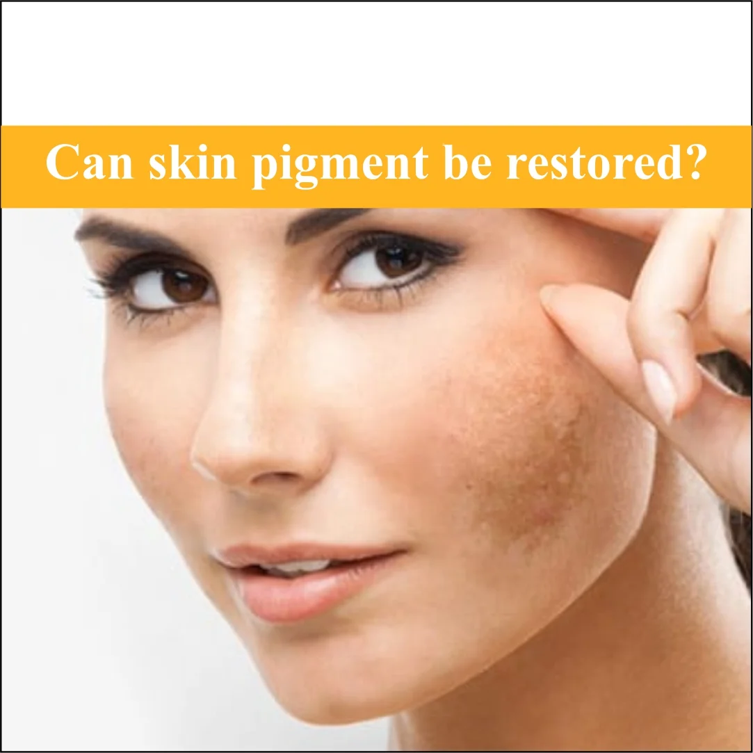 Can Skin Pigment Be Restored? - AAYNA Clinic