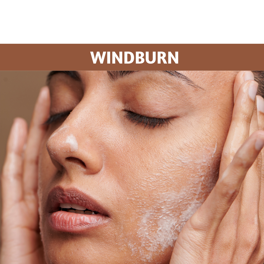 What is Windburn? All You Need to Know