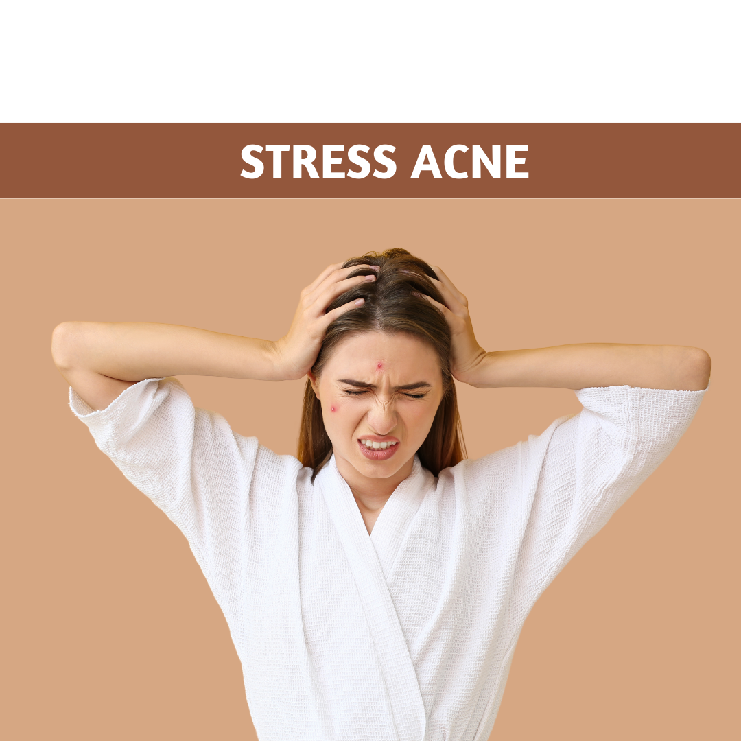 Stress Acne: Understanding and Managing It
