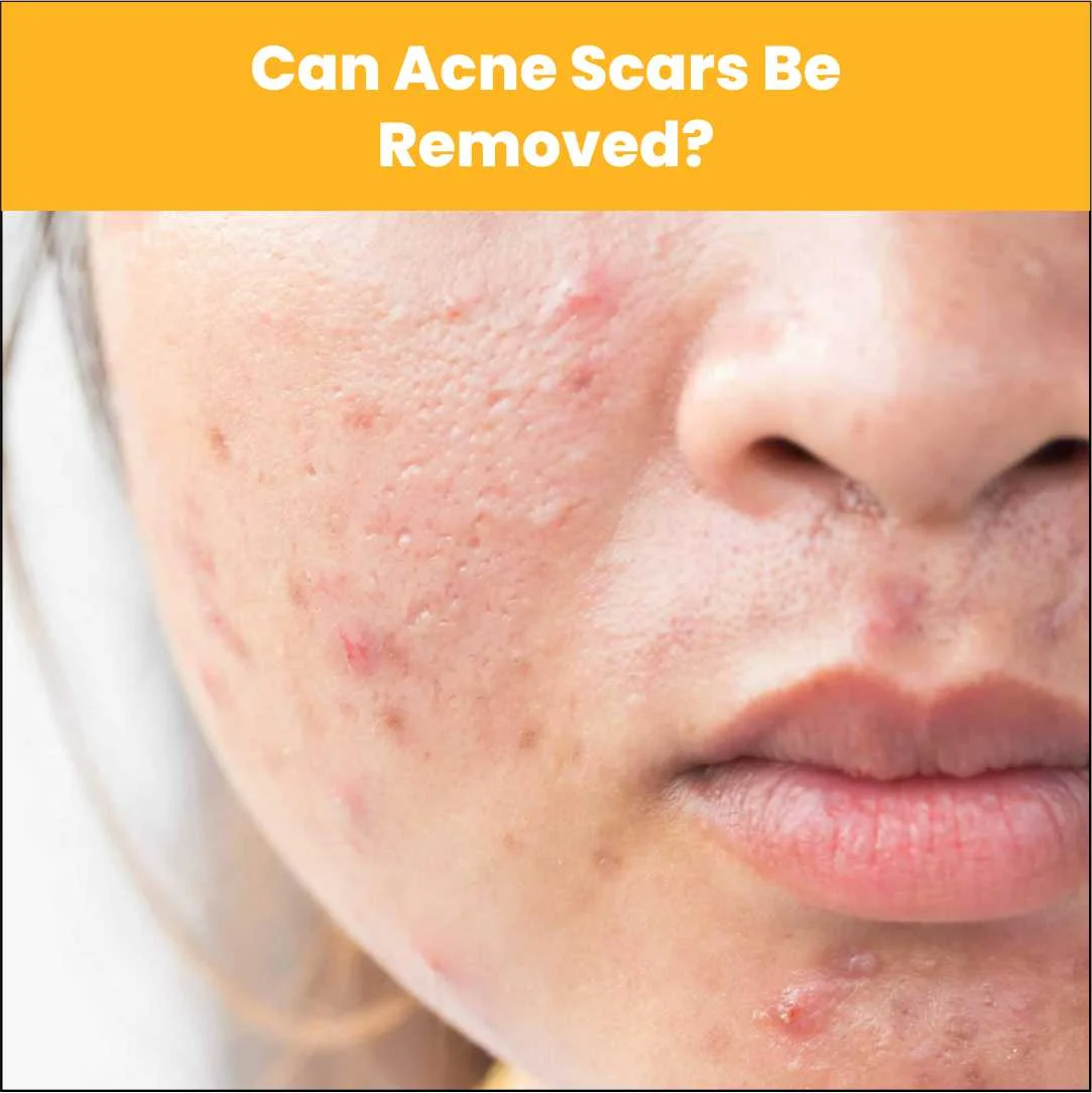 Can Acne Scars Be Removed? - AAYNA Clinic