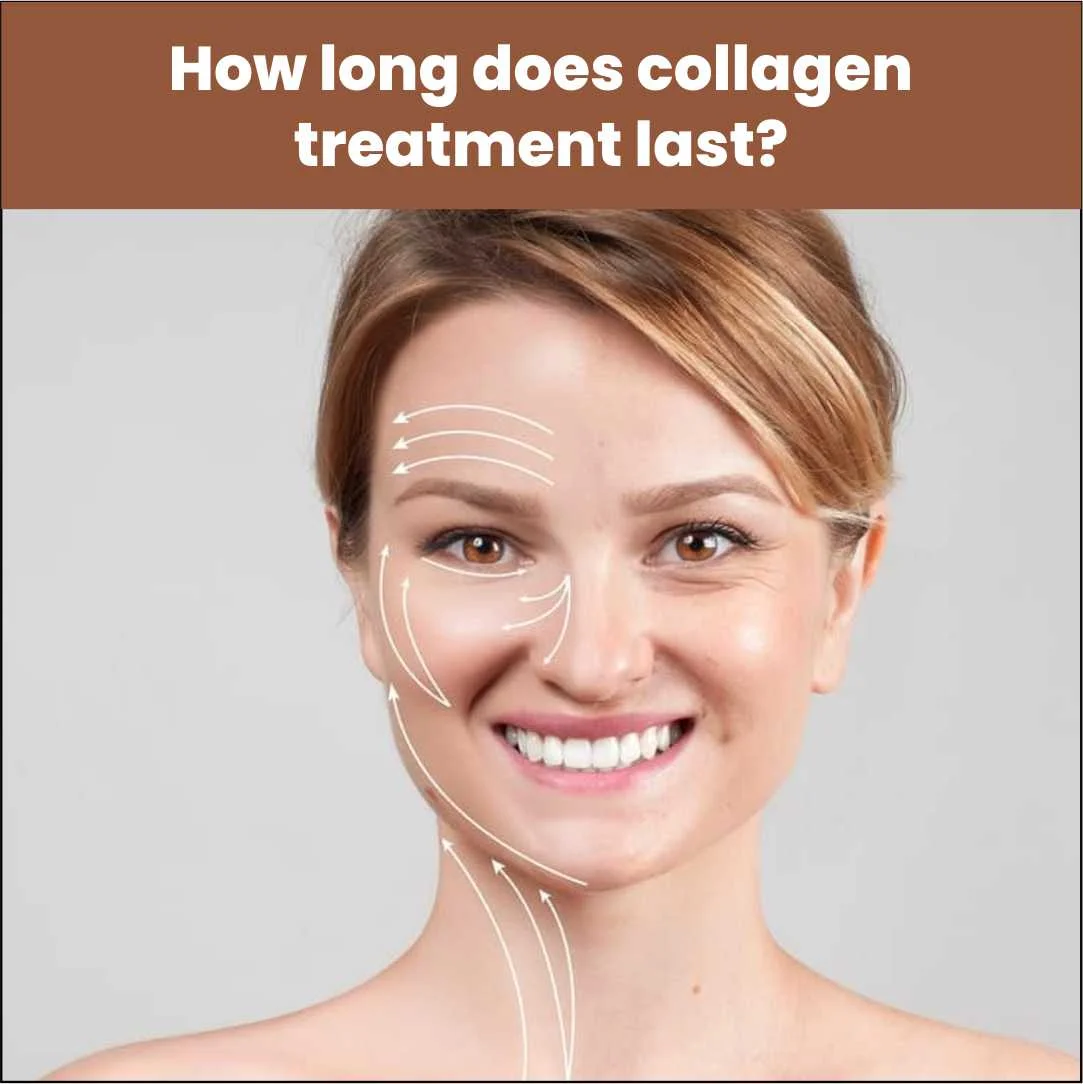 How Long Does Collagen Treatment Last? - AAYNA Clinic