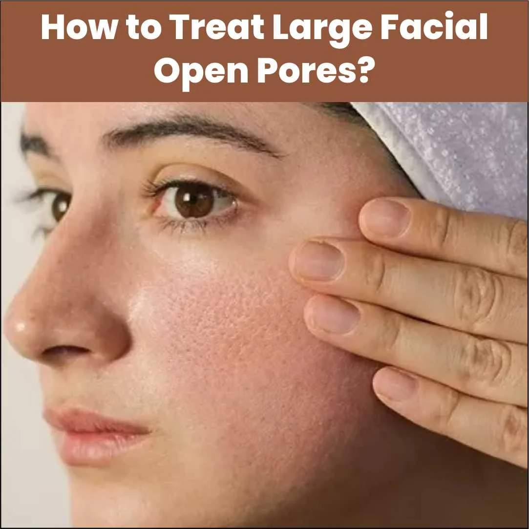 How to Treat Large Facial Open Pores? - AAYNA Clinic