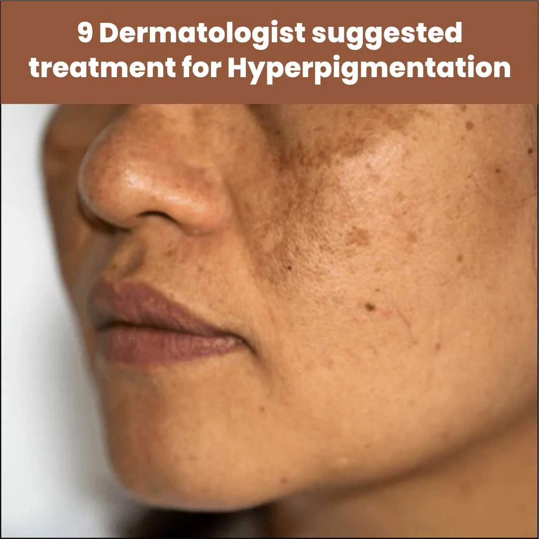 9 Dermatologist Treatments for Hyperpigmentation